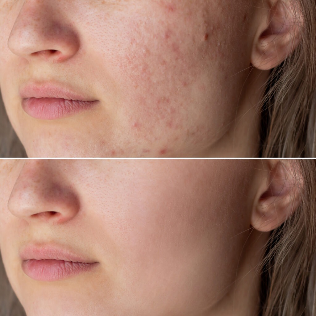 Scar Removal 2026 | Expert Treatments for All Scar Types